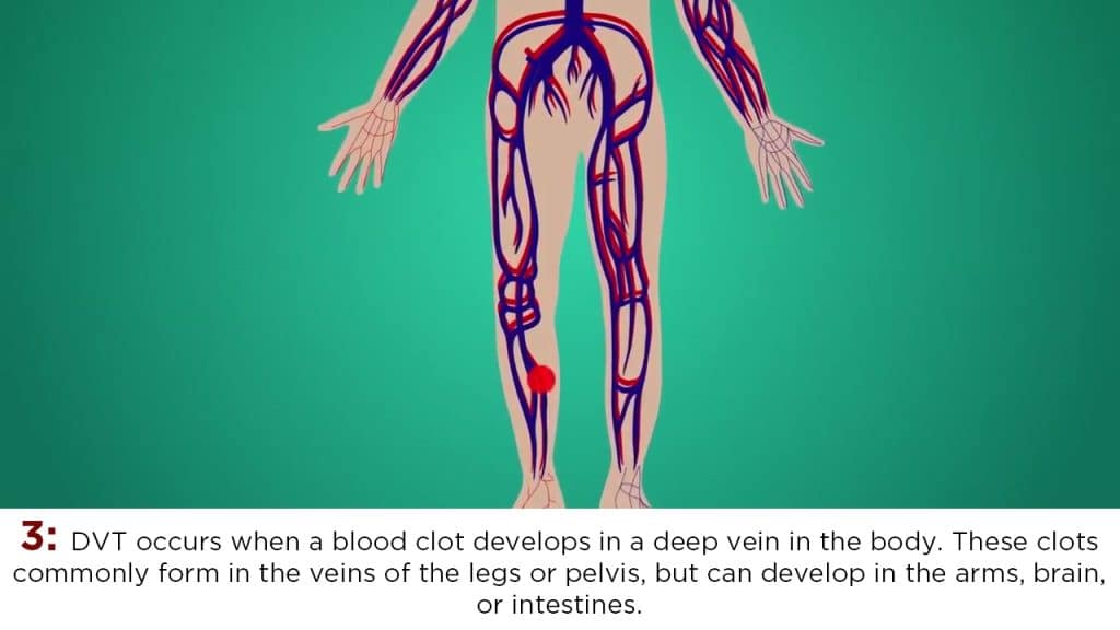 10 Things to Know About VTE - Alliance for Aging Research